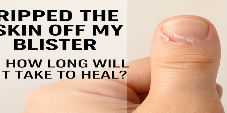 I Ripped the Skin Off My Blister – How Long Will It Take to Heal?